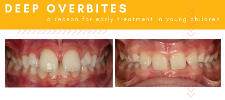 Orthodontic Habits and Problems in Kids | Hometown Orthodontics