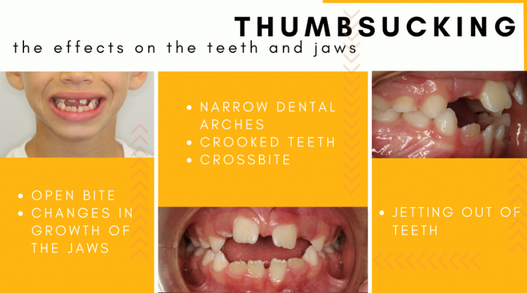 Orthodontic Habits and Problems in Kids | Hometown Orthodontics