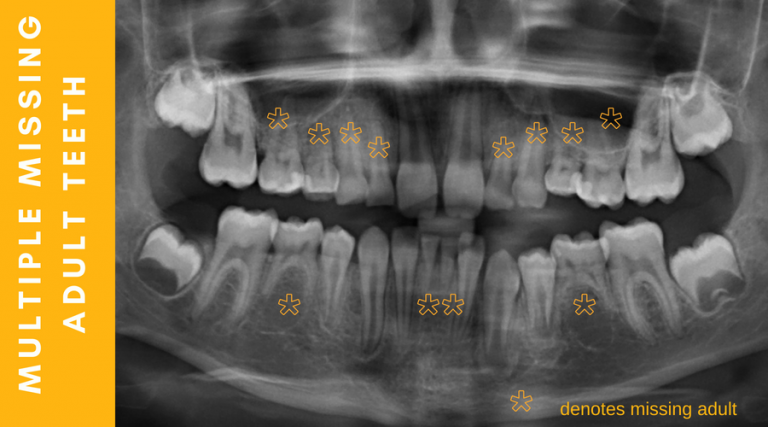 Delayed Tooth Eruption in Kids | Hometown Orthodontics