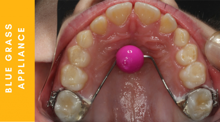 Orthodontic Habits and Problems in Kids | Hometown Orthodontics