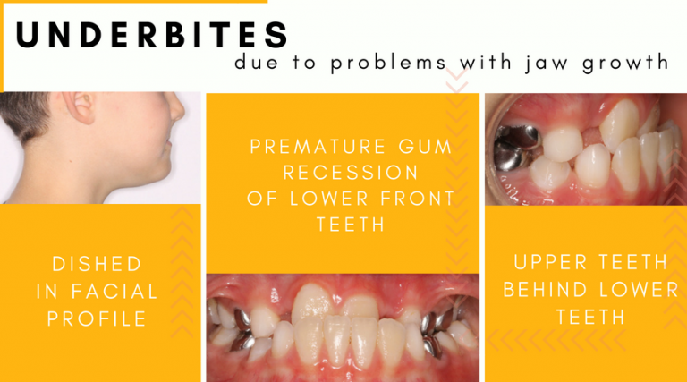 Correcting Underbites in Kids | Hometown Orthodontics